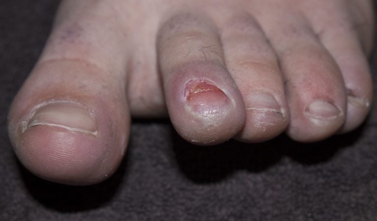 Subungual Hematoma: How to treat a bruised toenail at home - Daily Medicos