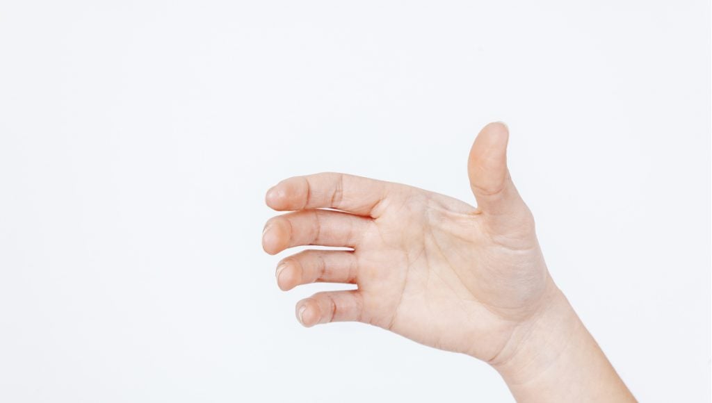 Ape Hand Deformity: It's Diagnosis And Treatment - Daily Medicos