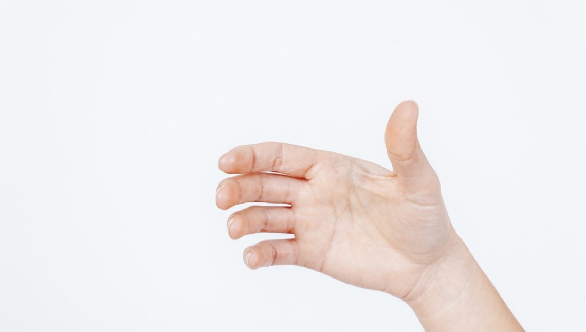 Ape Hand Deformity: It's Diagnosis And Treatment - Daily Medicos