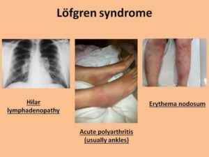 Lofgren Syndrome: Causes, Symptoms, & Treatment - Daily Medicos