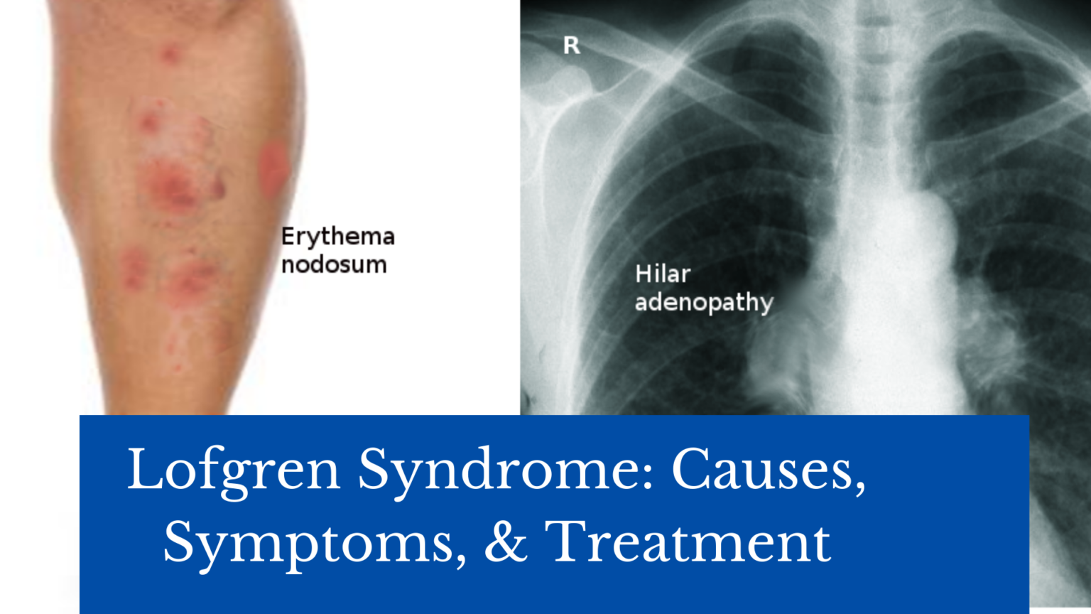 Lofgren Syndrome: Causes, Symptoms, & Treatment - Daily Medicos