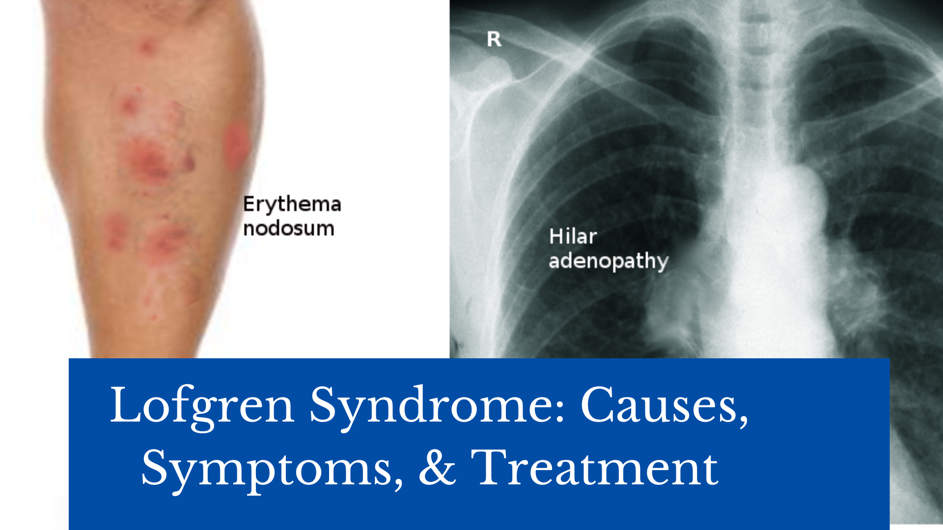 Lofgren Syndrome: Causes, Symptoms, & Treatment - Daily Medicos