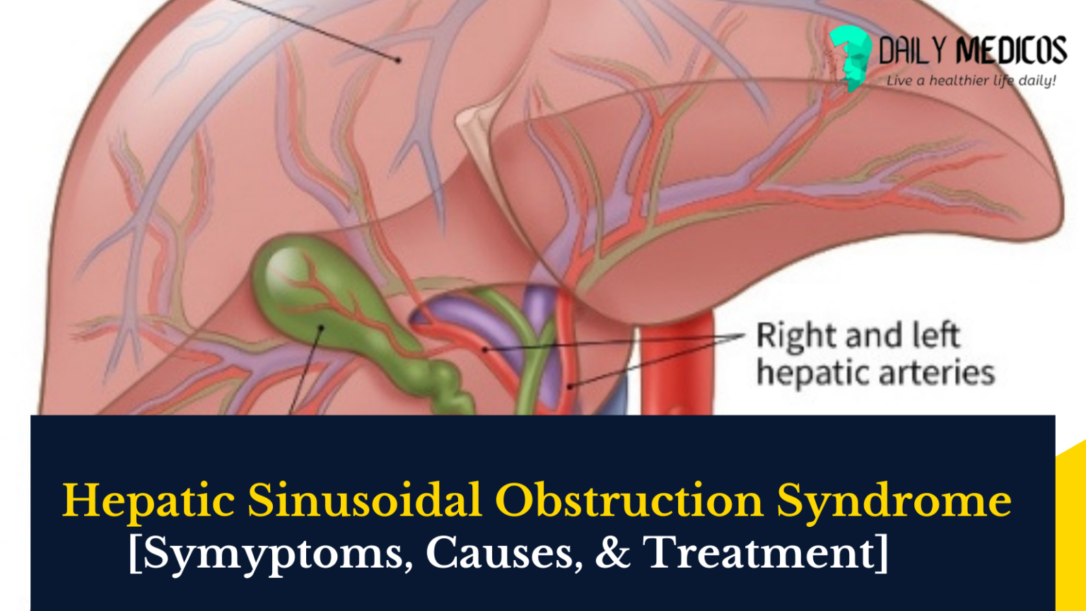 Hepatic Sinusoidal Obstruction Syndrome: All You Need to Know ...