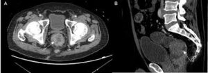 Osmotic Demyelination Syndrome: All You Need To Know - Daily Medicos