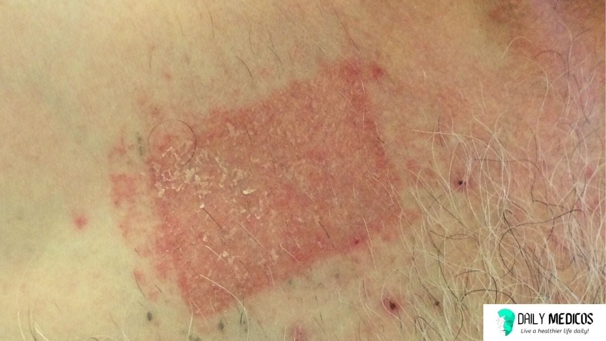 7 Ways to Get Rid of an Armpit Rash - Daily Medicos